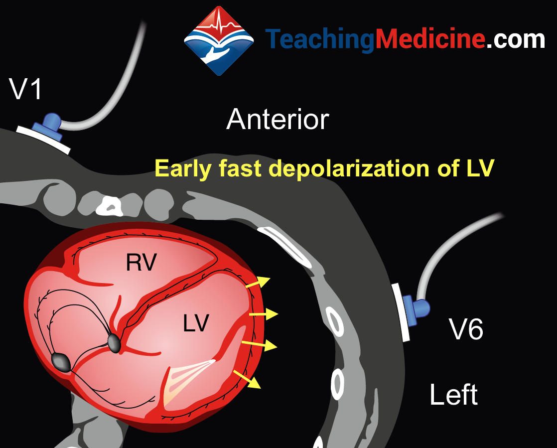 Teaching Medicine - Tutorial: Bundle Branch Blocks
